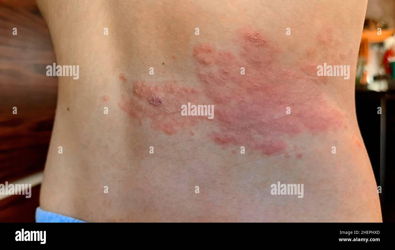 shingles rash on the rear Stock Photo - Alamy