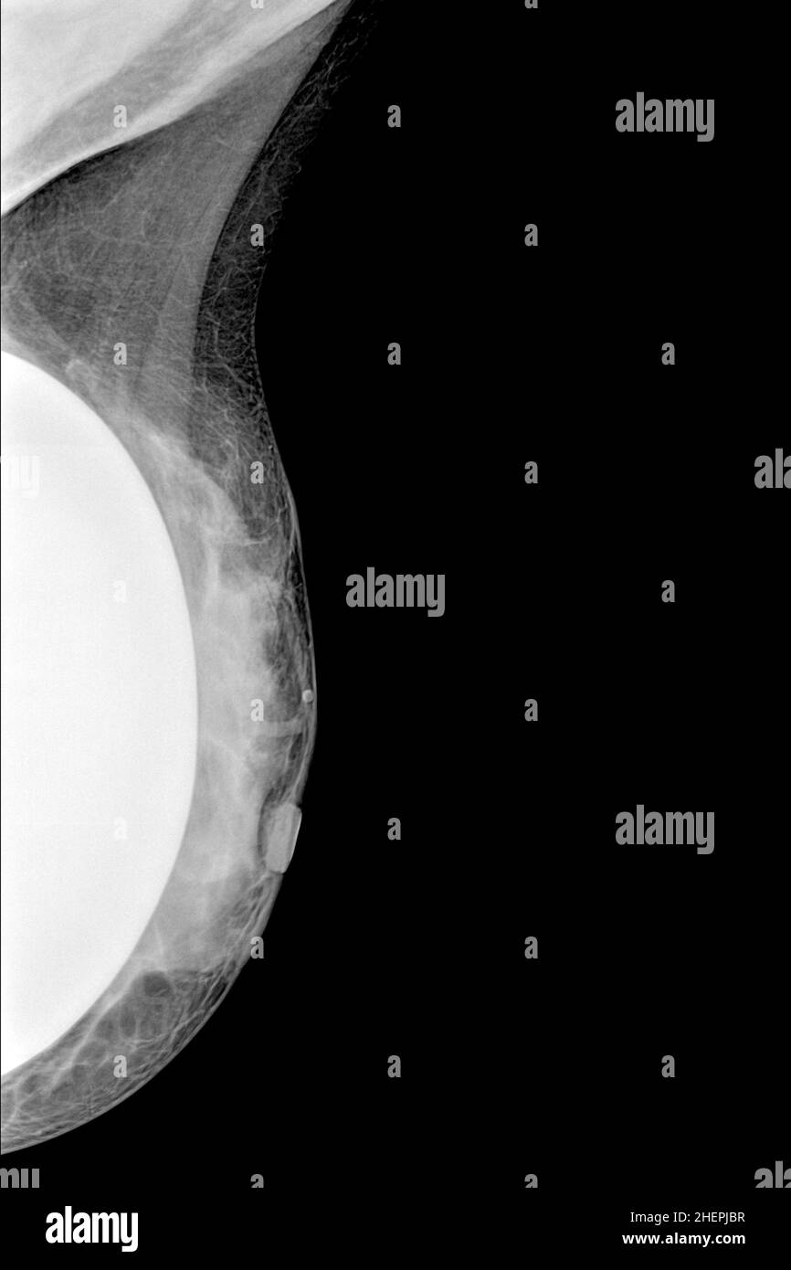 Mammography in middle-lateral projection of a left breast for the ...