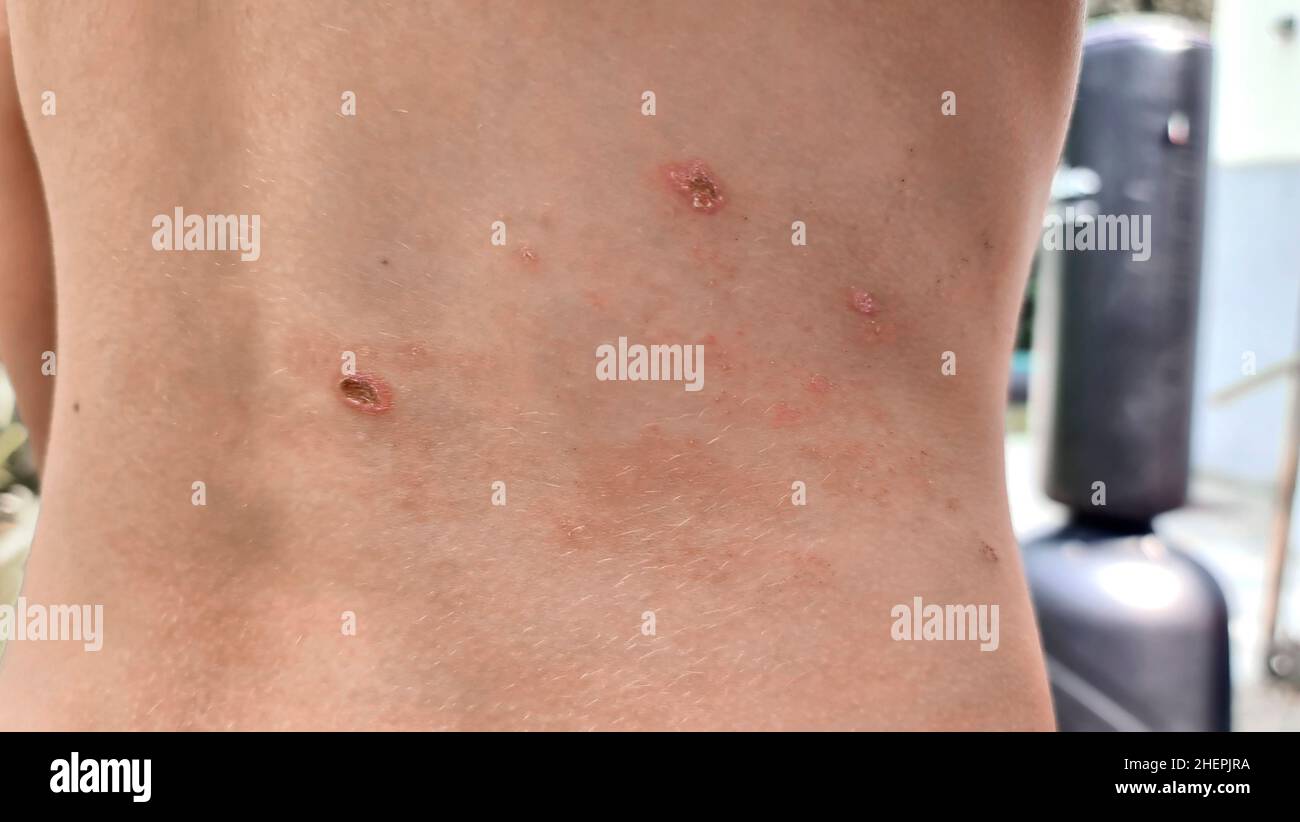 remittent shingles rash on the rear Stock Photo - Alamy