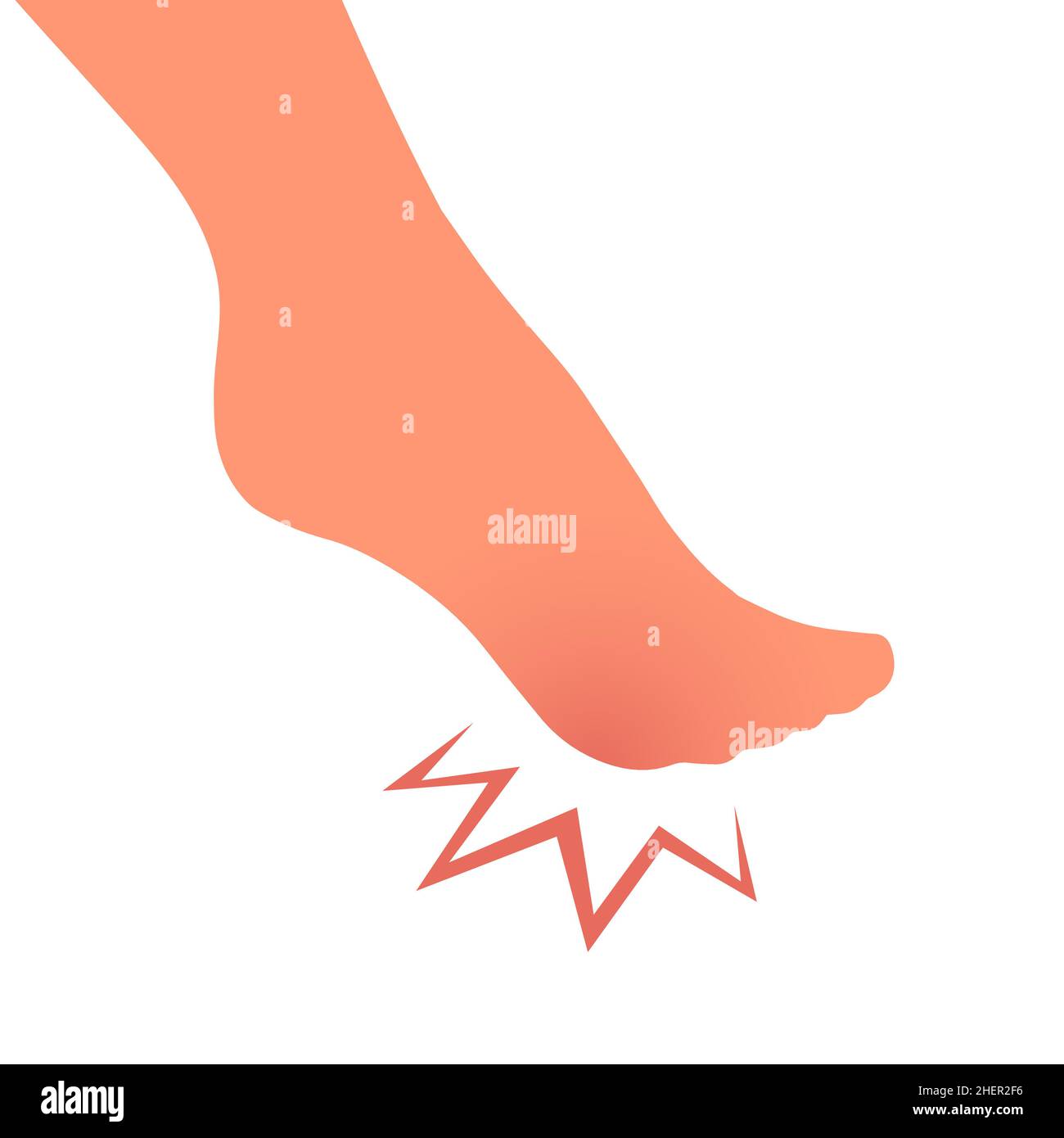 A woman leg with a sore callus. Transverse flat feet. Orthopedic ...