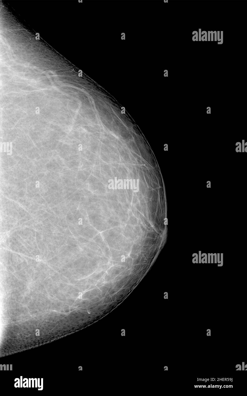 Mammography in caudal-skull projection of a left breast for the breast ...