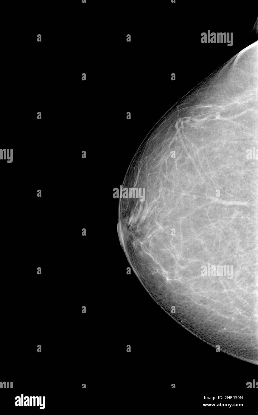 Mammography in caudal-skull projection of a right breast for the breast ...