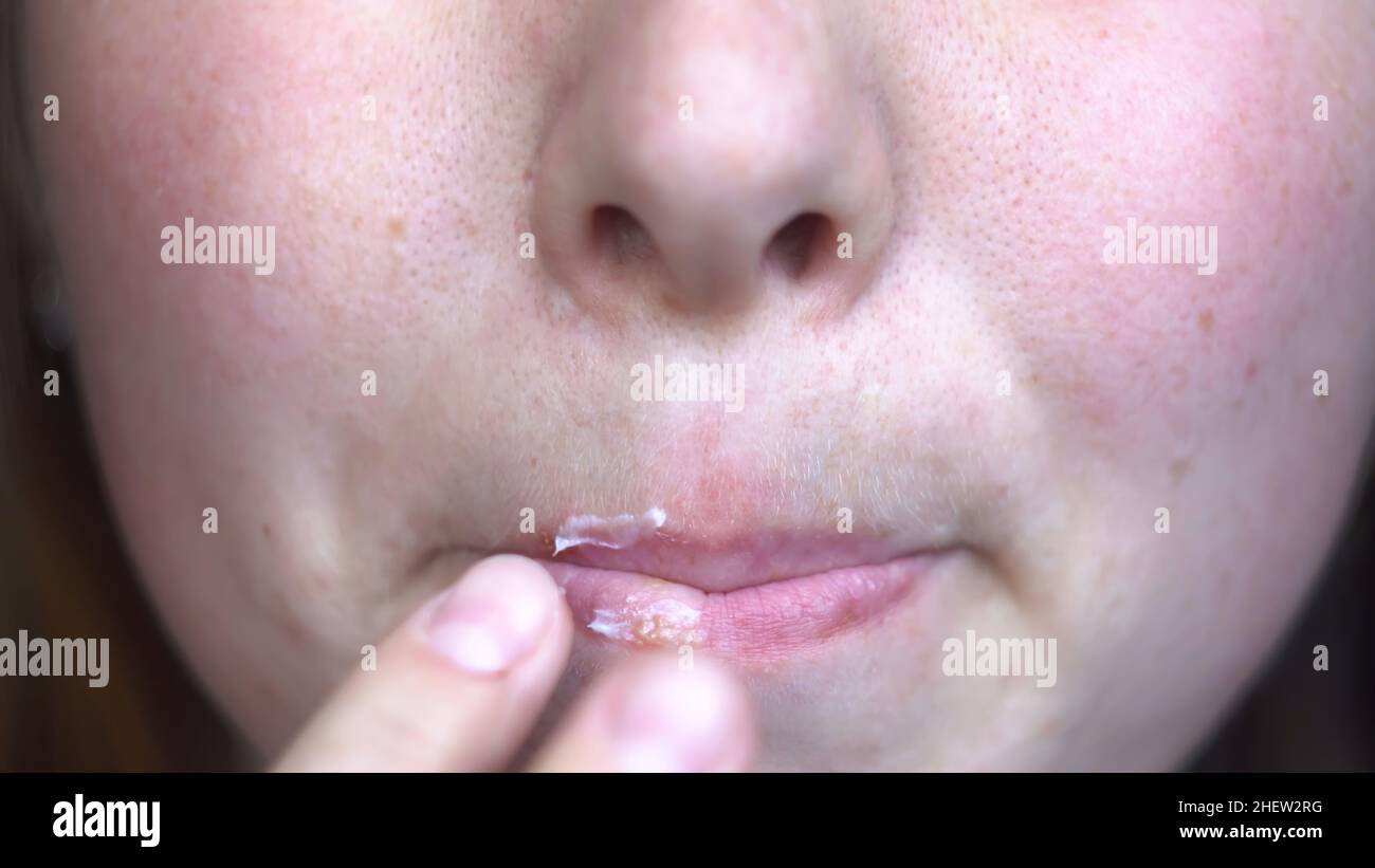 Herpes stomatitis hi-res stock photography and images - Alamy