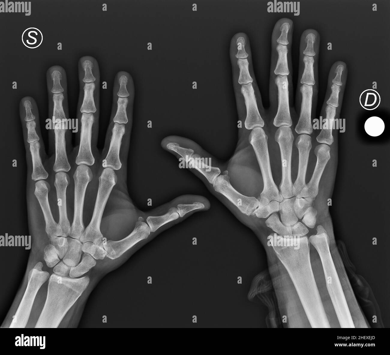 X ray hand hi-res stock photography and images - Alamy