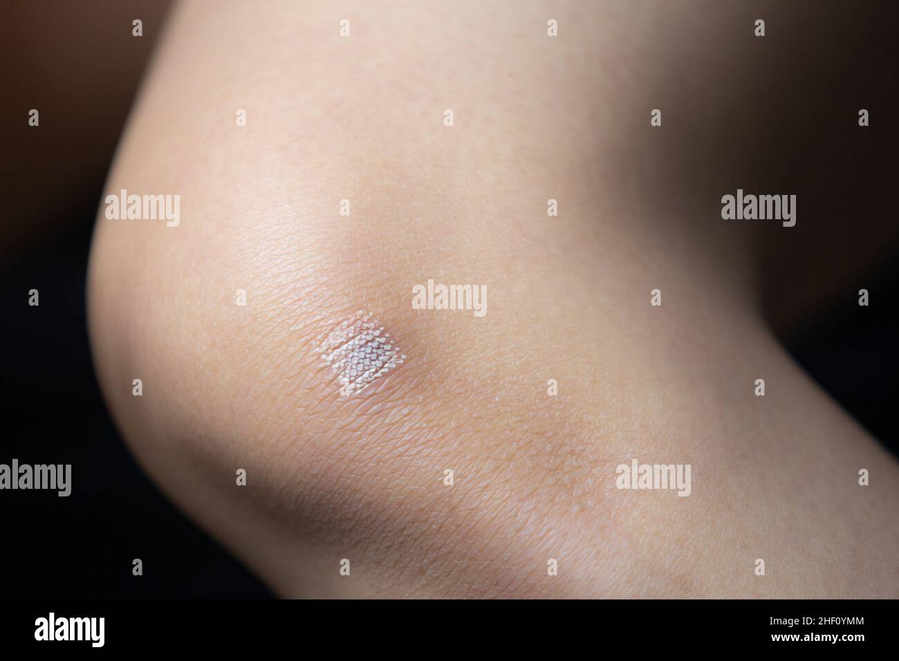Marks after laser hair or atopic eczema scar removal from the skin. CO2 ...