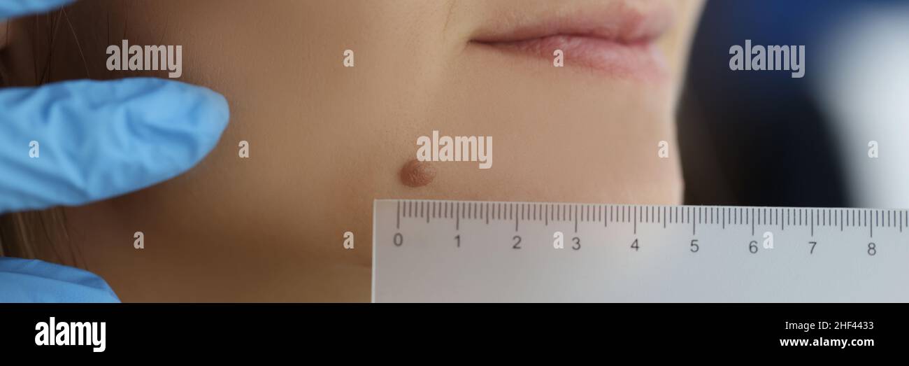 Detailed picture of birthmark Stock Photo - Alamy