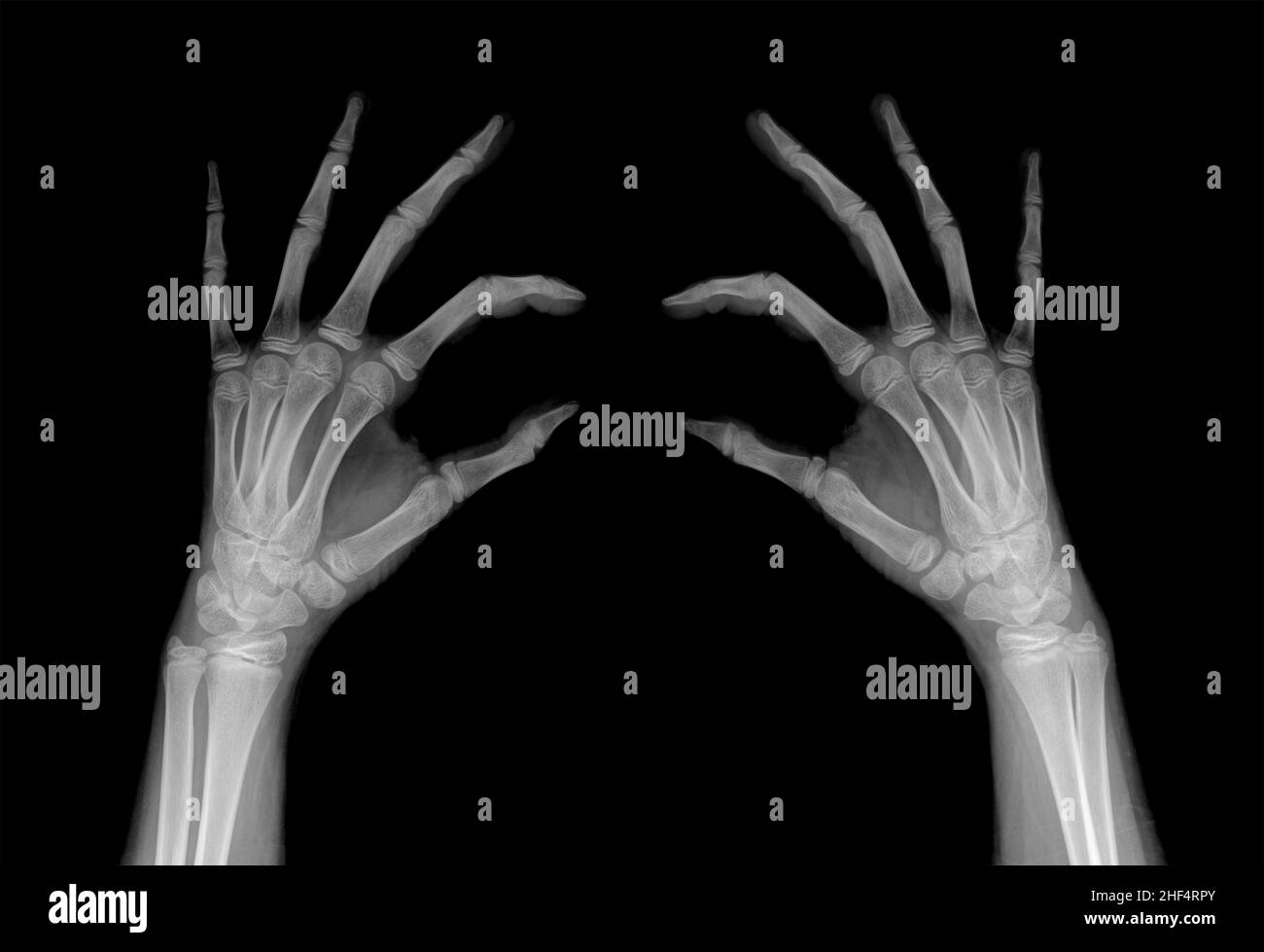 Radiography of the fingers of the hands in comparison Stock Photo - Alamy