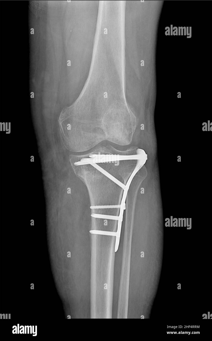 Radiography of the operated Tibia, in antero-posterior projection, in a ...