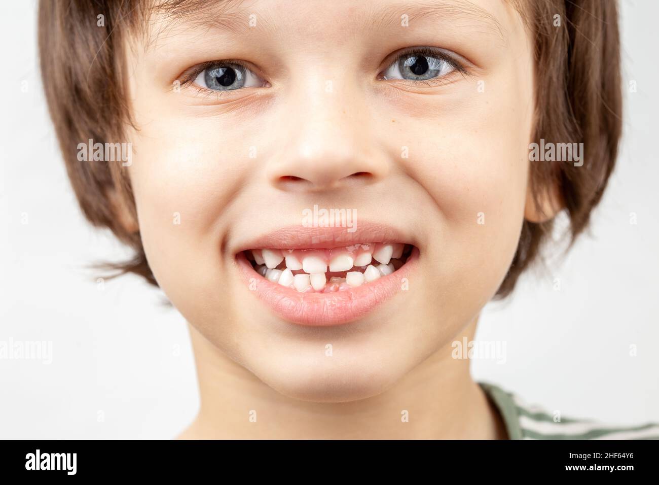 White boy without one bottom front tooth. Dental health concept Stock ...