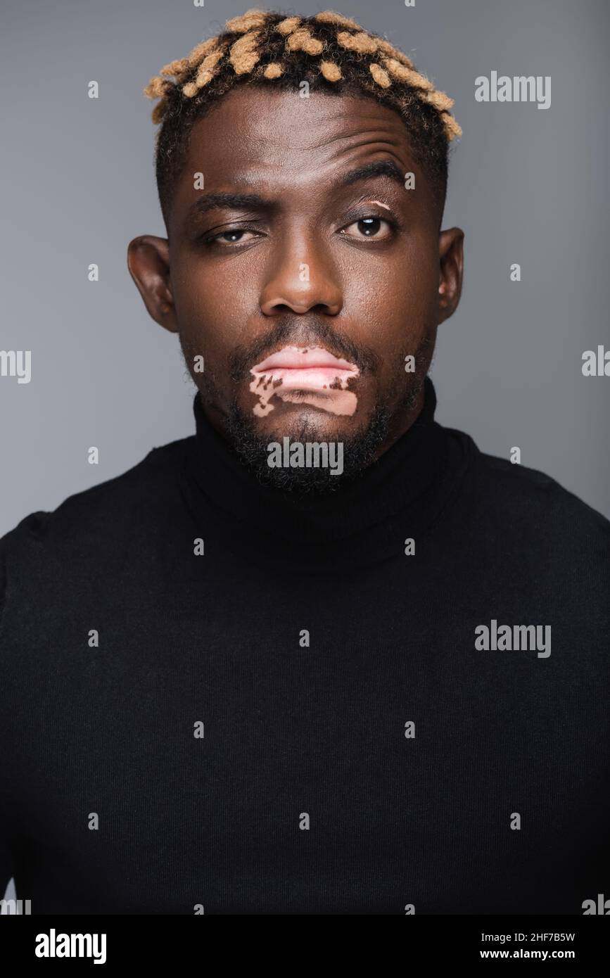 African skin pigmentation hi-res stock photography and images - Alamy