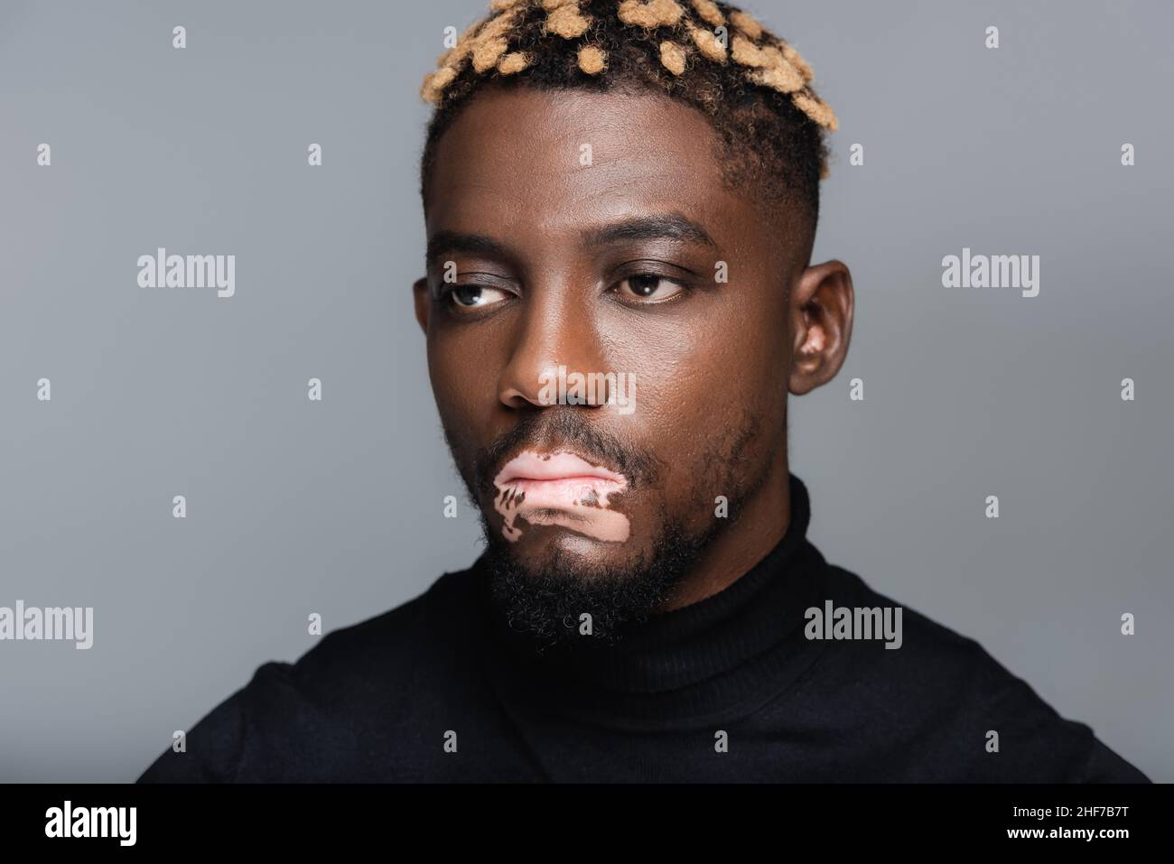 portrait of young african american man with vitiligo and trendy ...