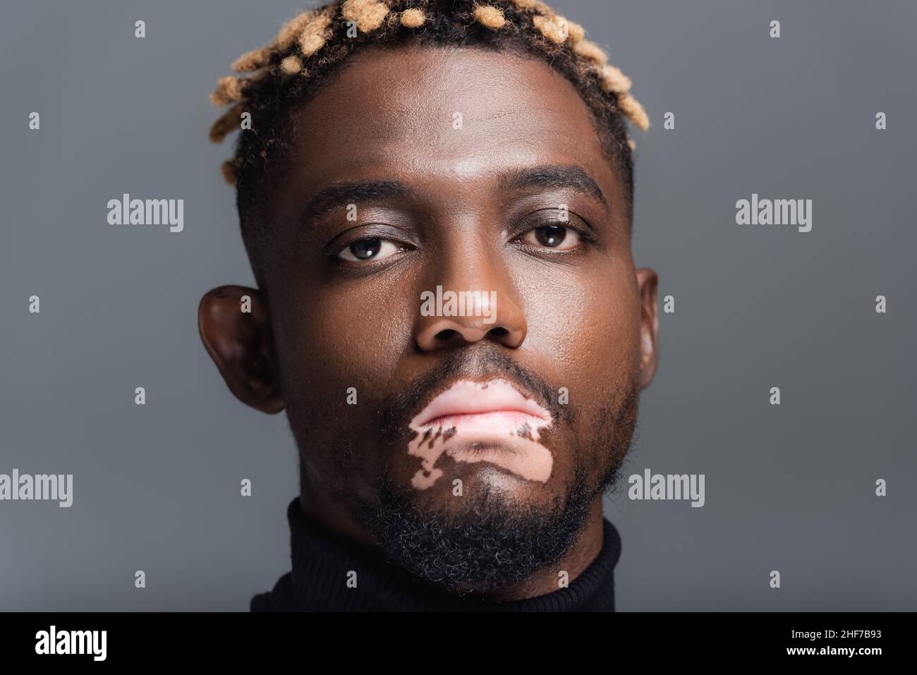 portrait of african american man with vitiligo skin and trendy ...