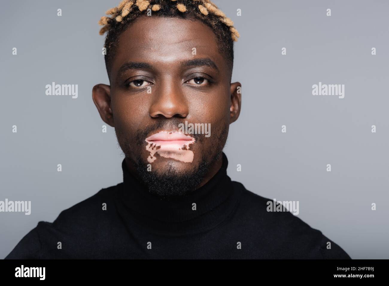 young african american man with vitiligo, wearing black turtleneck ...