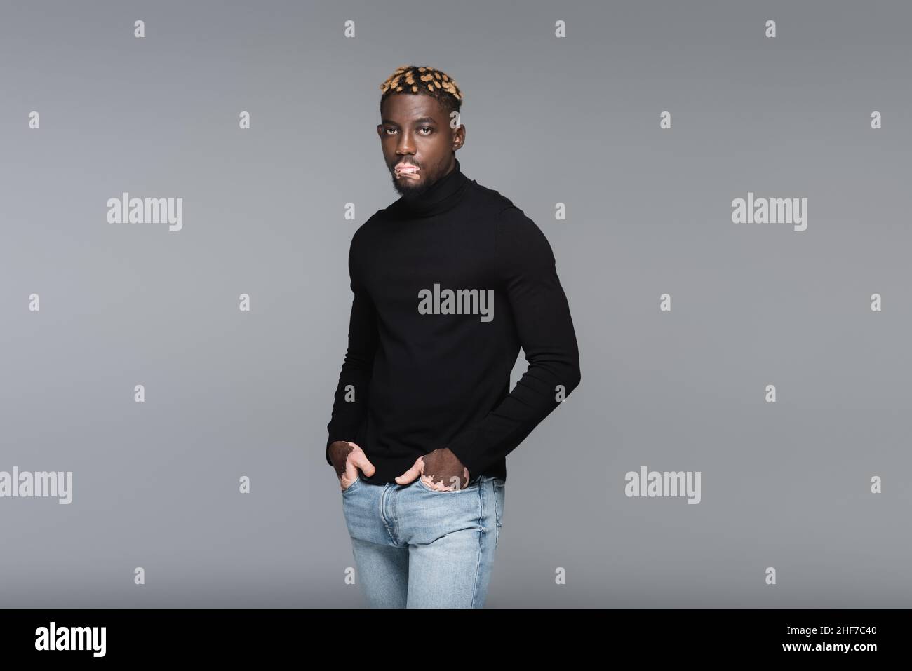 trendy african american man with vitiligo skin standing with hands in ...
