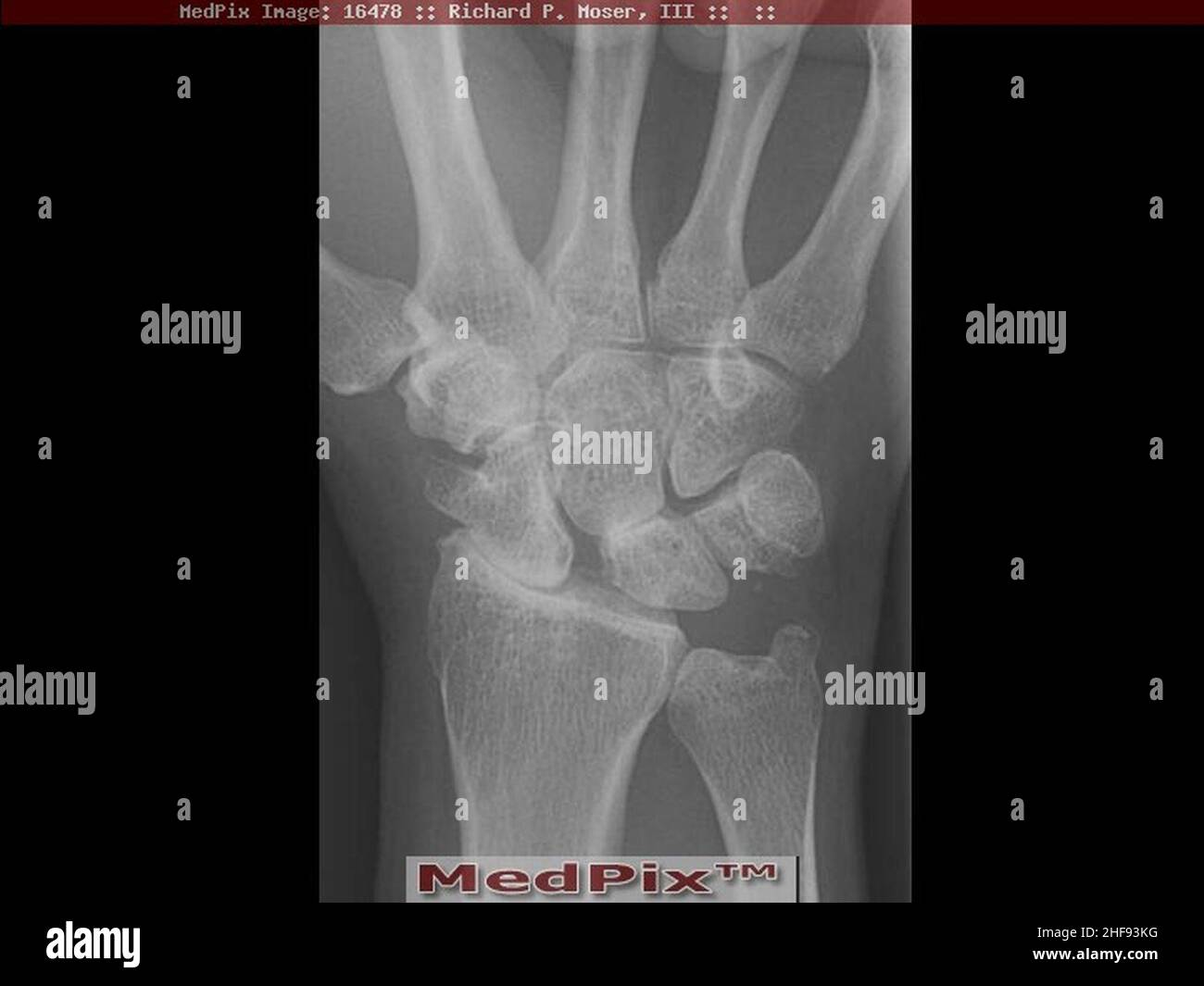 Scapholunate advanced collapse wrist posteroanterior Stock Photo - Alamy