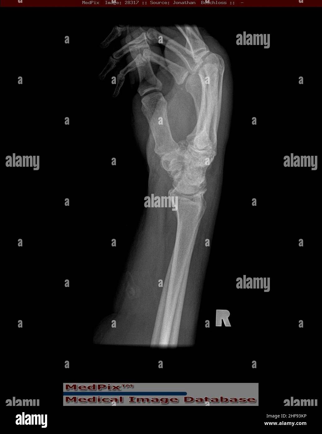 Scapholunate advanced collapse wrist lateral view Stock Photo - Alamy