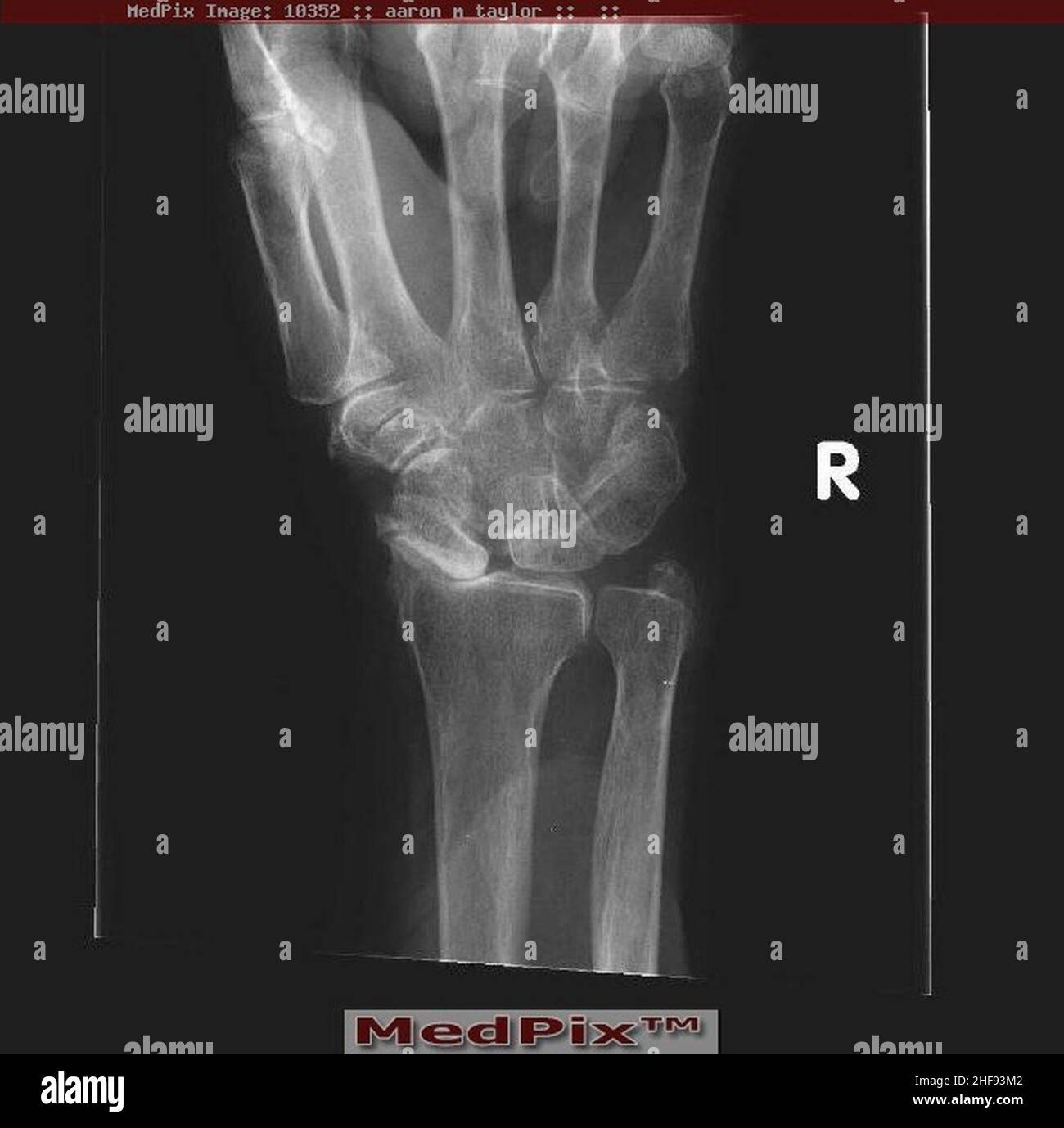 Scapholunate dissociation and SLAC wrist Stock Photo - Alamy