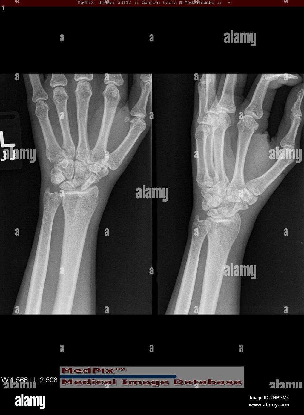 Scapholunate advanced collapse wrist AP Stock Photo - Alamy