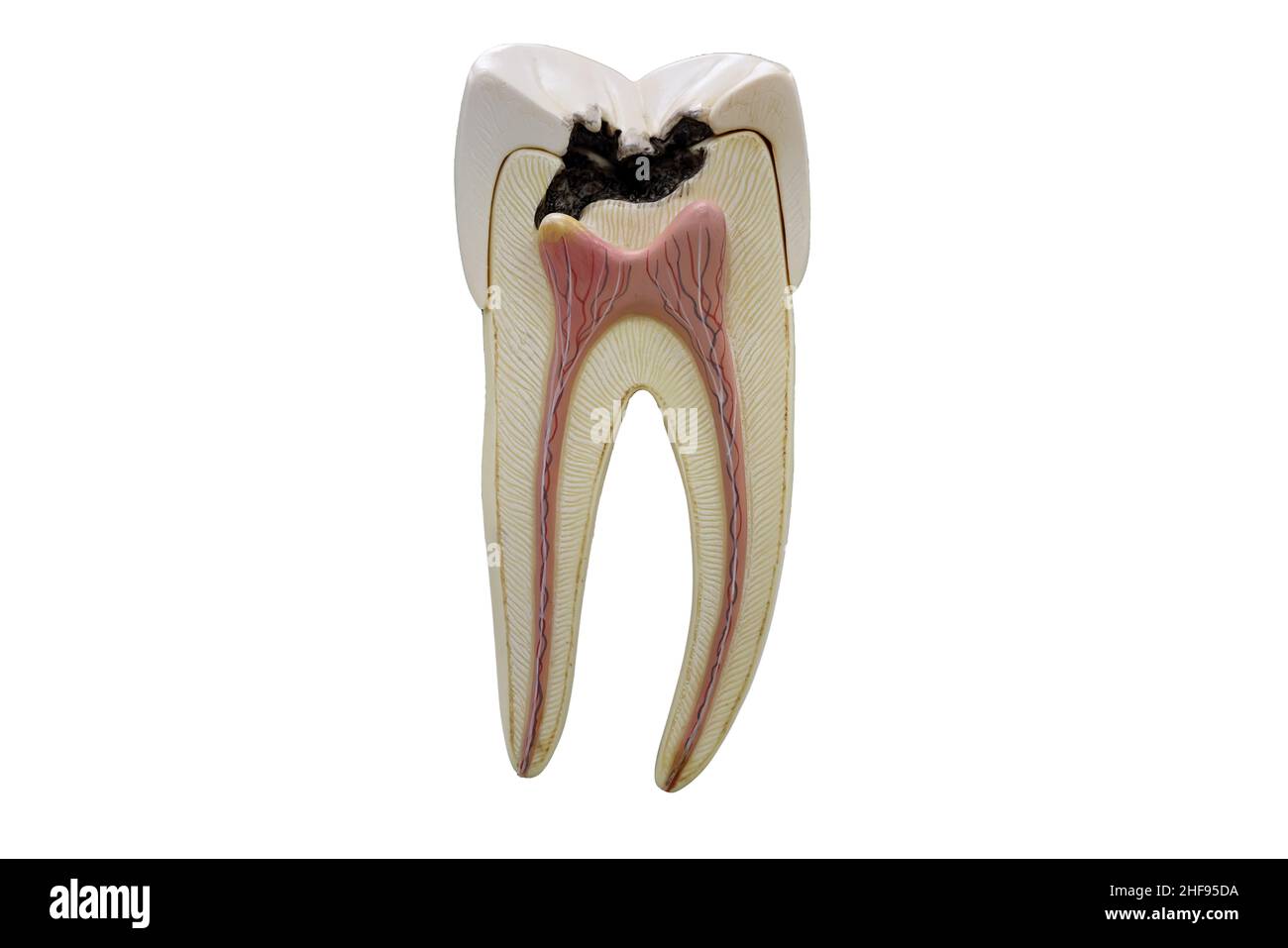 Tooth decay model Stock Photo - Alamy