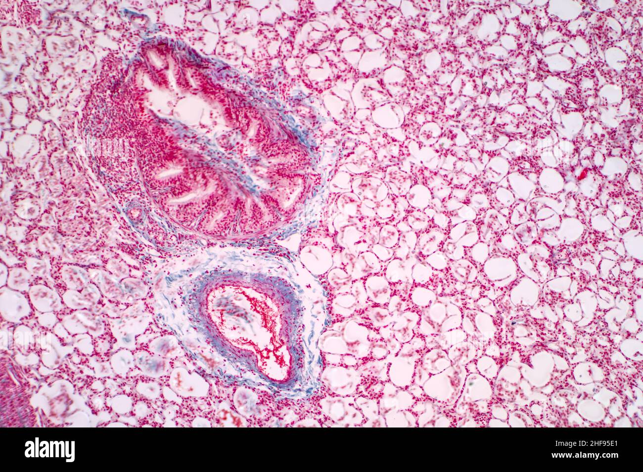 Human lung tissue, light micrograph Stock Photo - Alamy