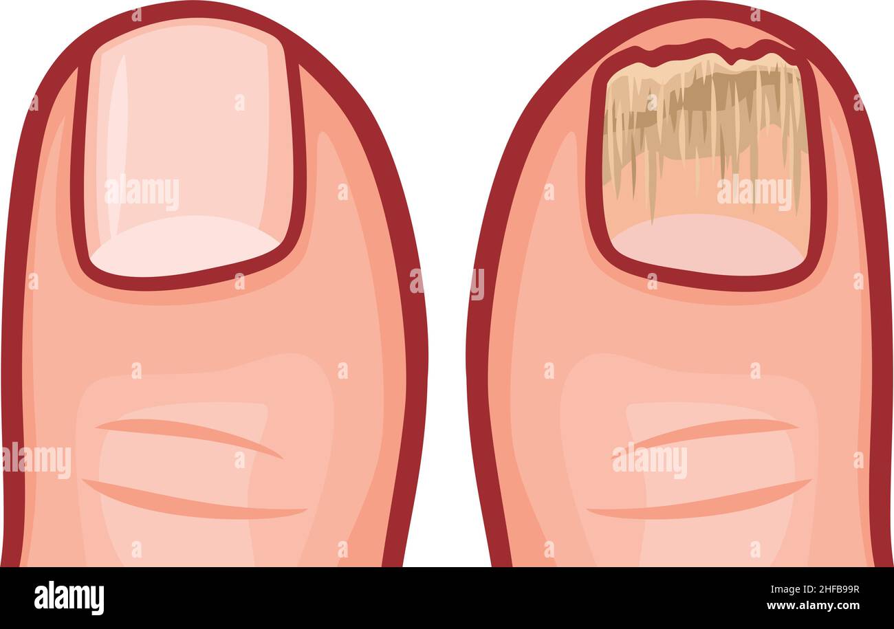 Fungal infection of the nails vector illustration Stock Vector Image ...