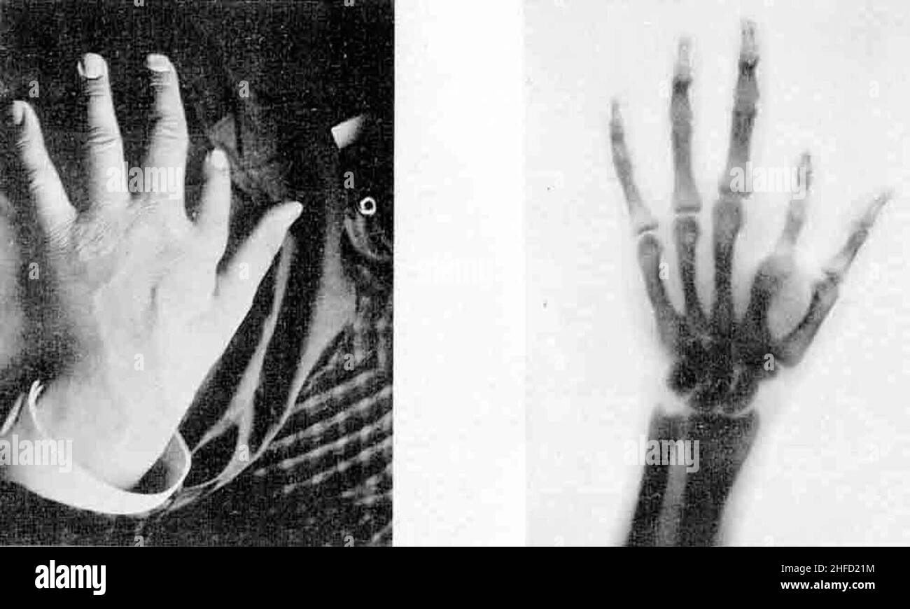 One of the first medical images of X-ray use. Publised in 1896 Stock ...