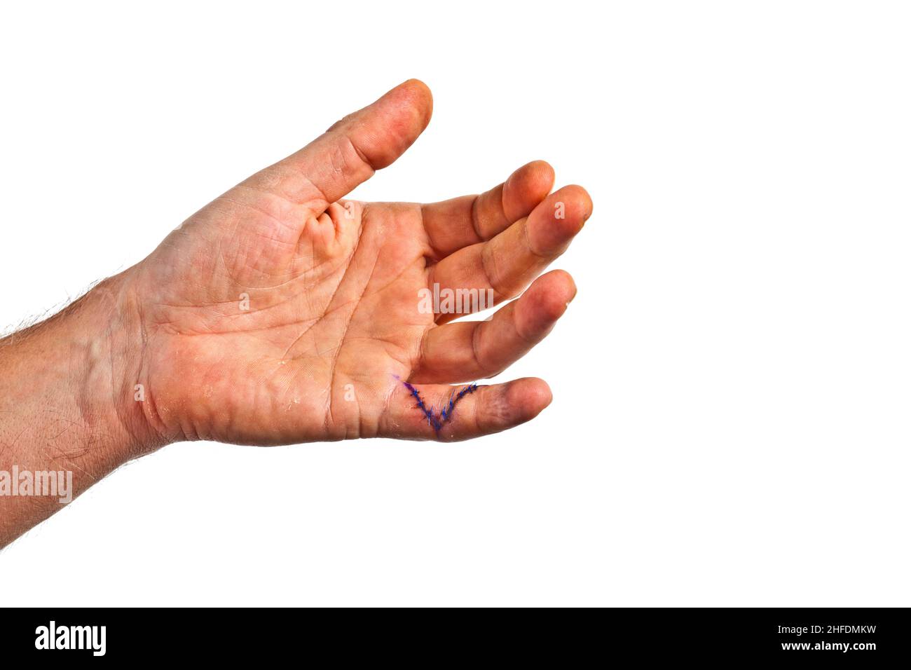 hand with an operation wound at the small finger Stock Photo - Alamy