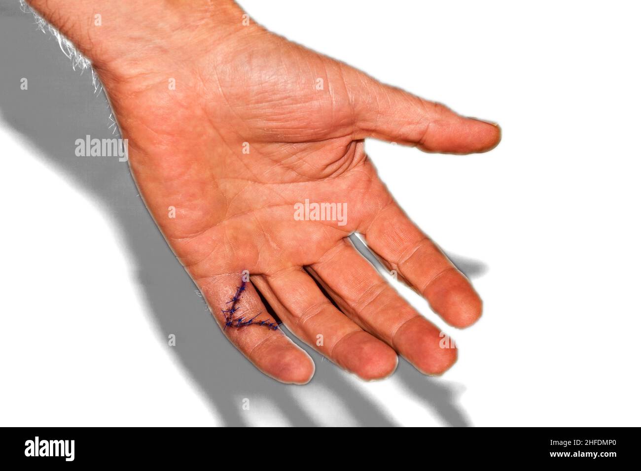 little finger stitched after an operation Stock Photo - Alamy