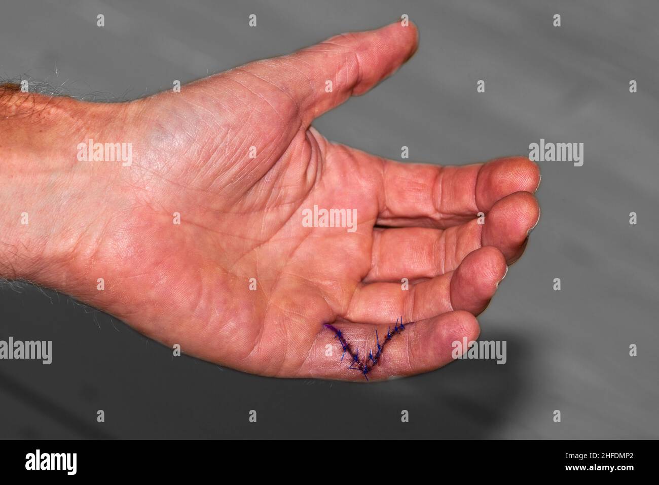 little finger stitched after an operation Stock Photo - Alamy