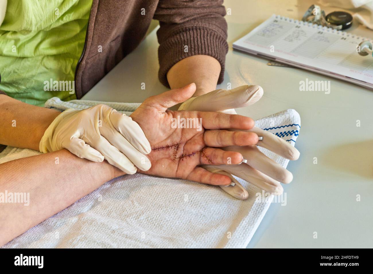 hand physiotherapy to recover a broken finger Stock Photo - Alamy