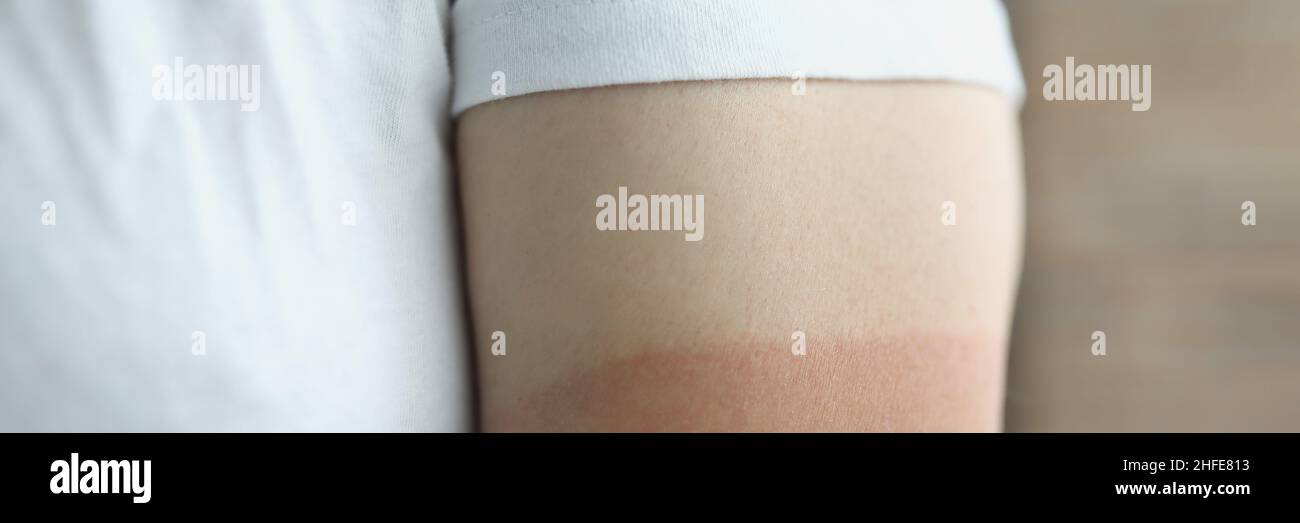 Uneven tan on the skin of a mans hand in a T-shirt Stock Photo - Alamy