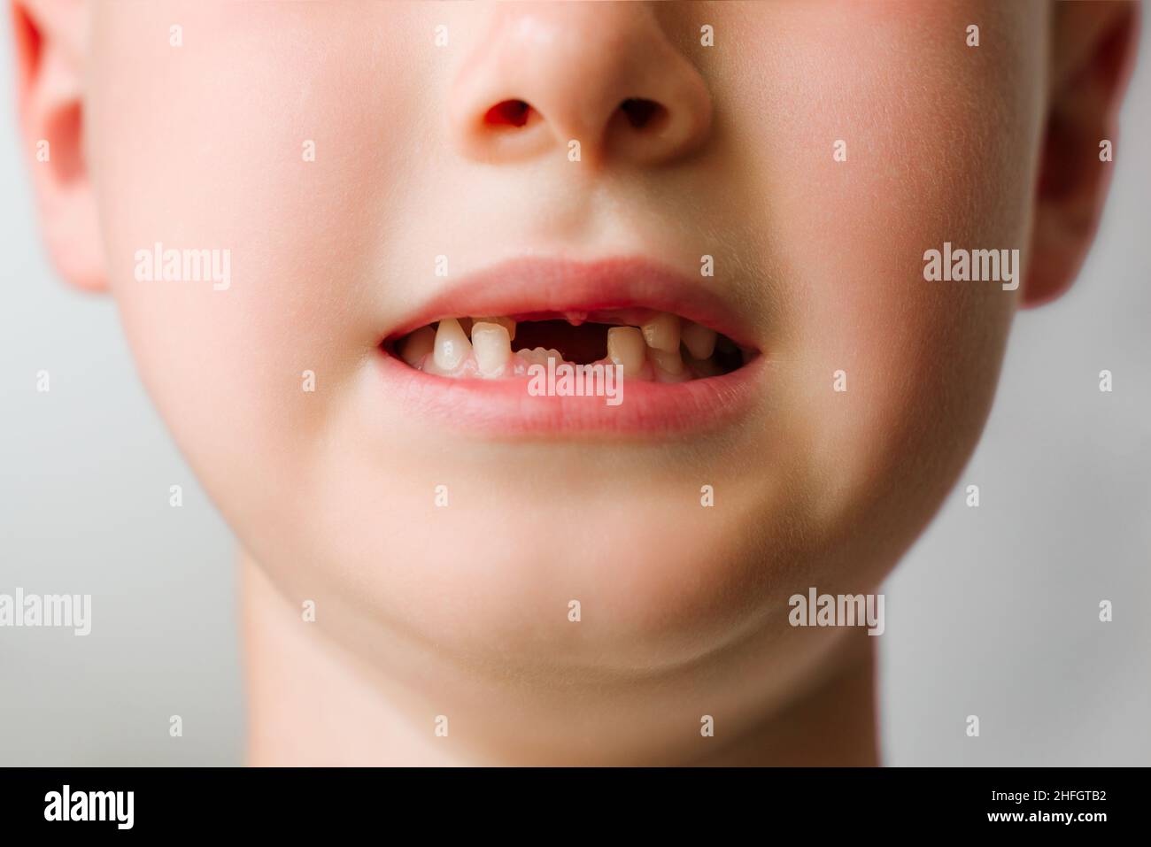 Kid teeth molars hi-res stock photography and images - Alamy