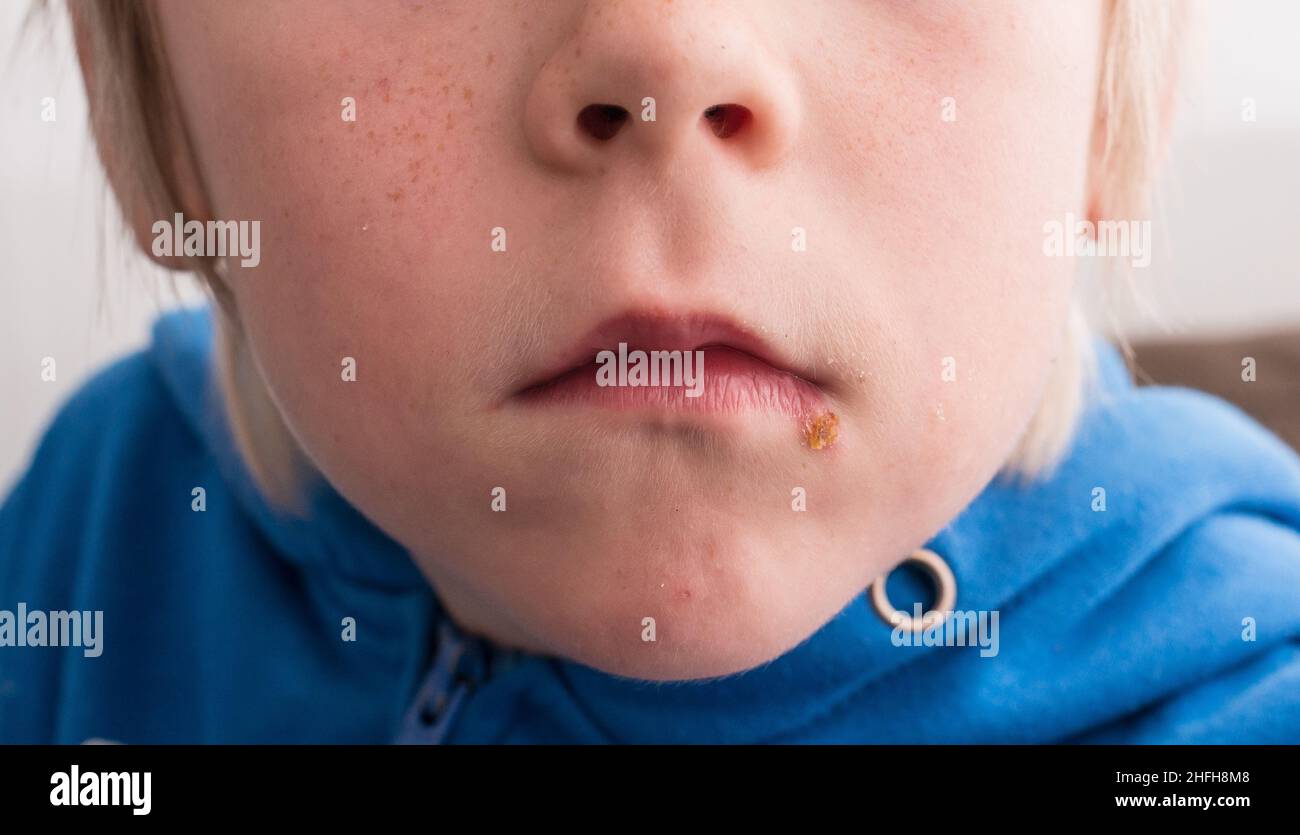 Impetigo child hi-res stock photography and images - Alamy