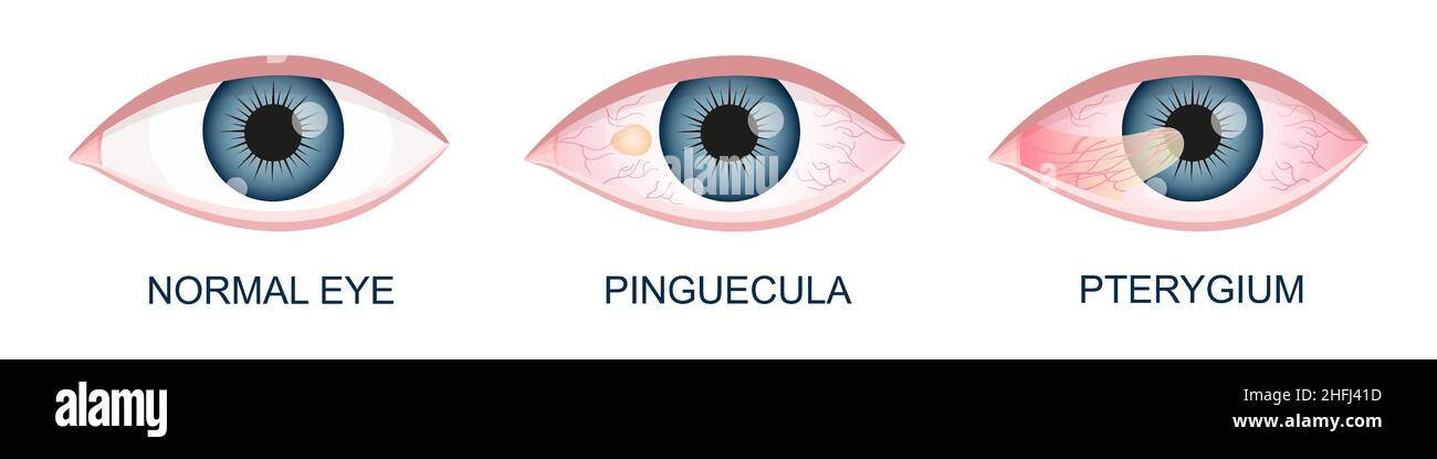 Conjunctival Stock Vector Images - Alamy