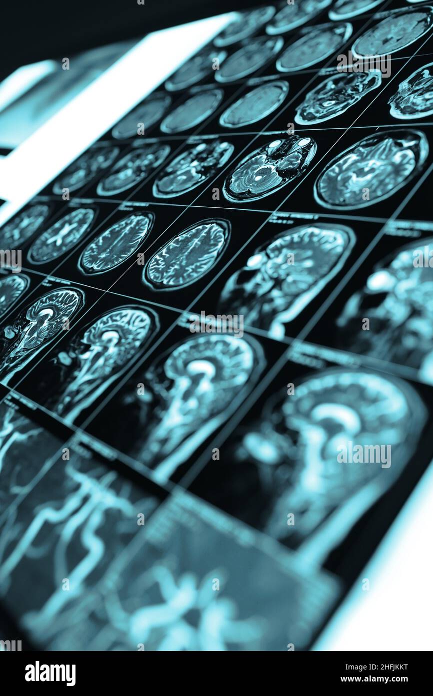 MRI film close-up on the view box in the hospital room Stock Photo - Alamy