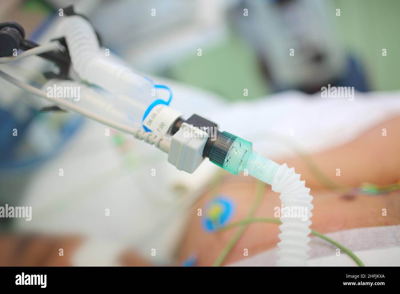 Patient in the ICU connected to the artificial lung ventilation system ...
