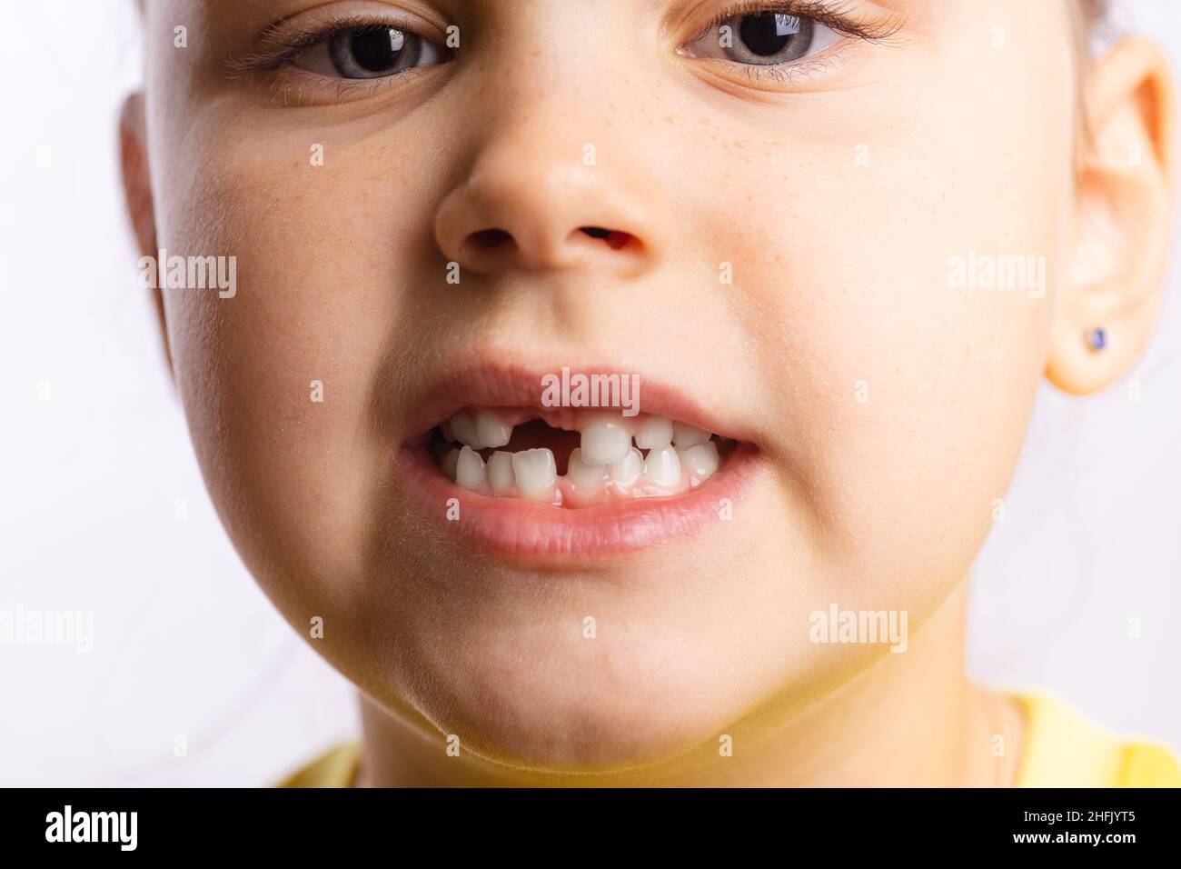 Close-up of young girl face showing missing front baby tooth looking at ...