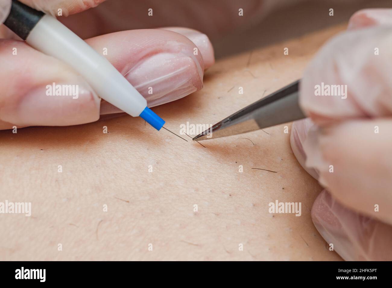 The process of permanent hair removal, removing unwanted hair using an ...