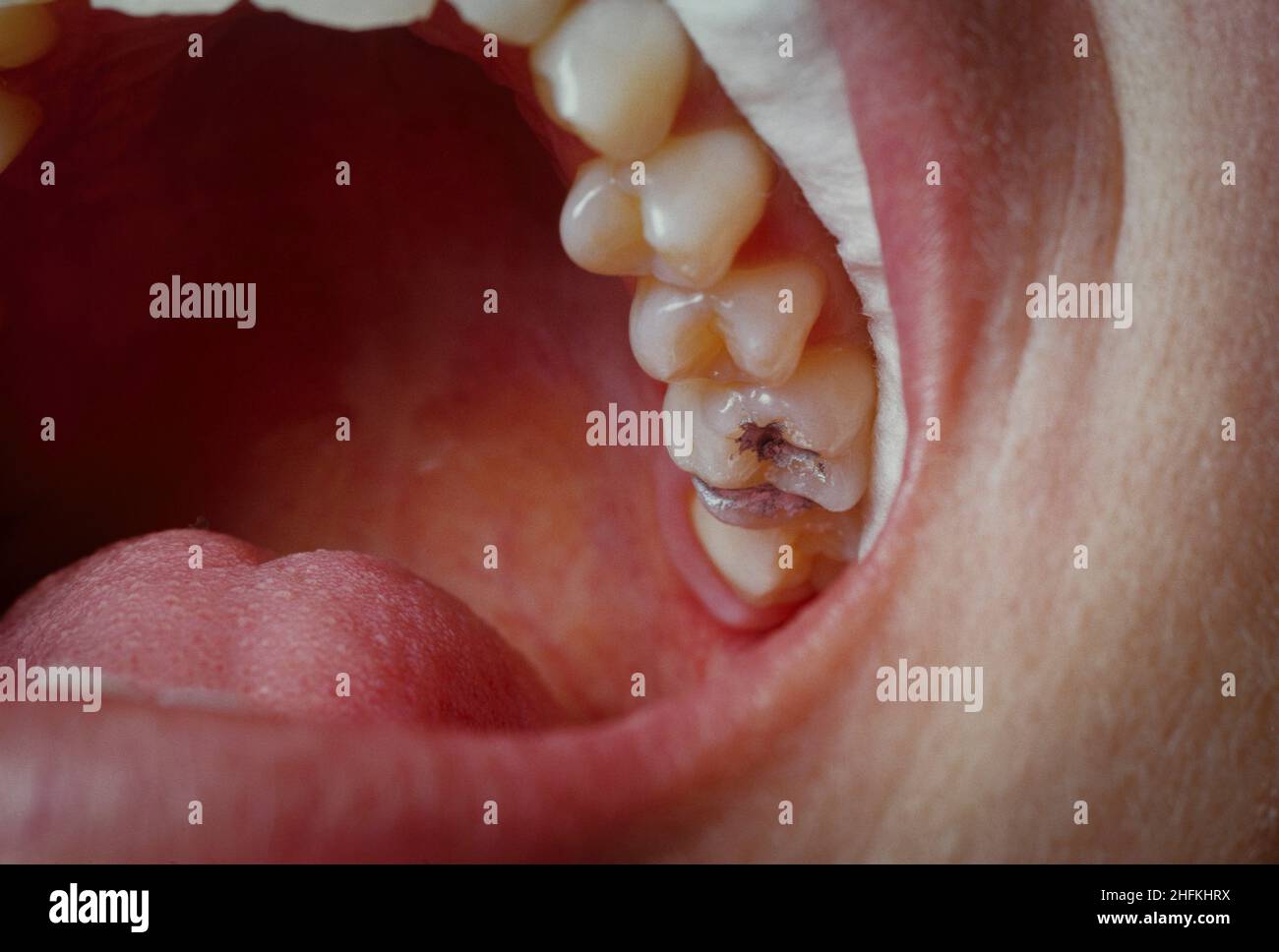 Fixed my teeth hi-res stock photography and images - Alamy