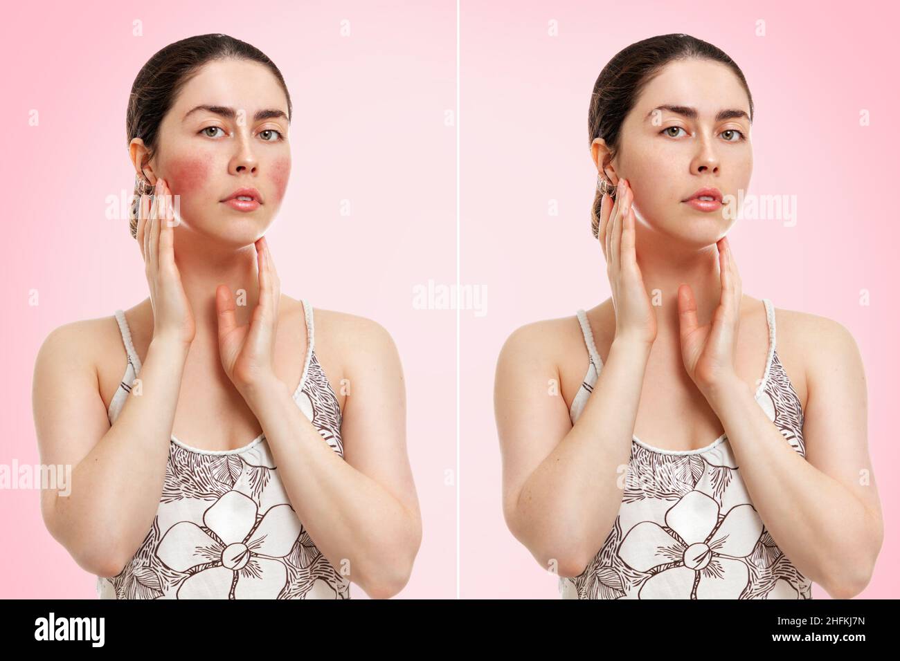 Portrait of a young Caucasian woman showing redness and inflamed blood ...