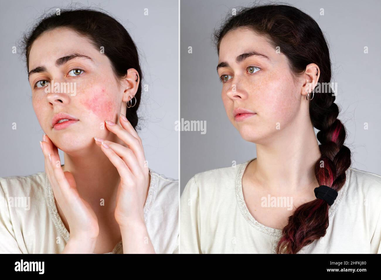 Portrait of a young Caucasian woman showing redness and inflamed blood ...