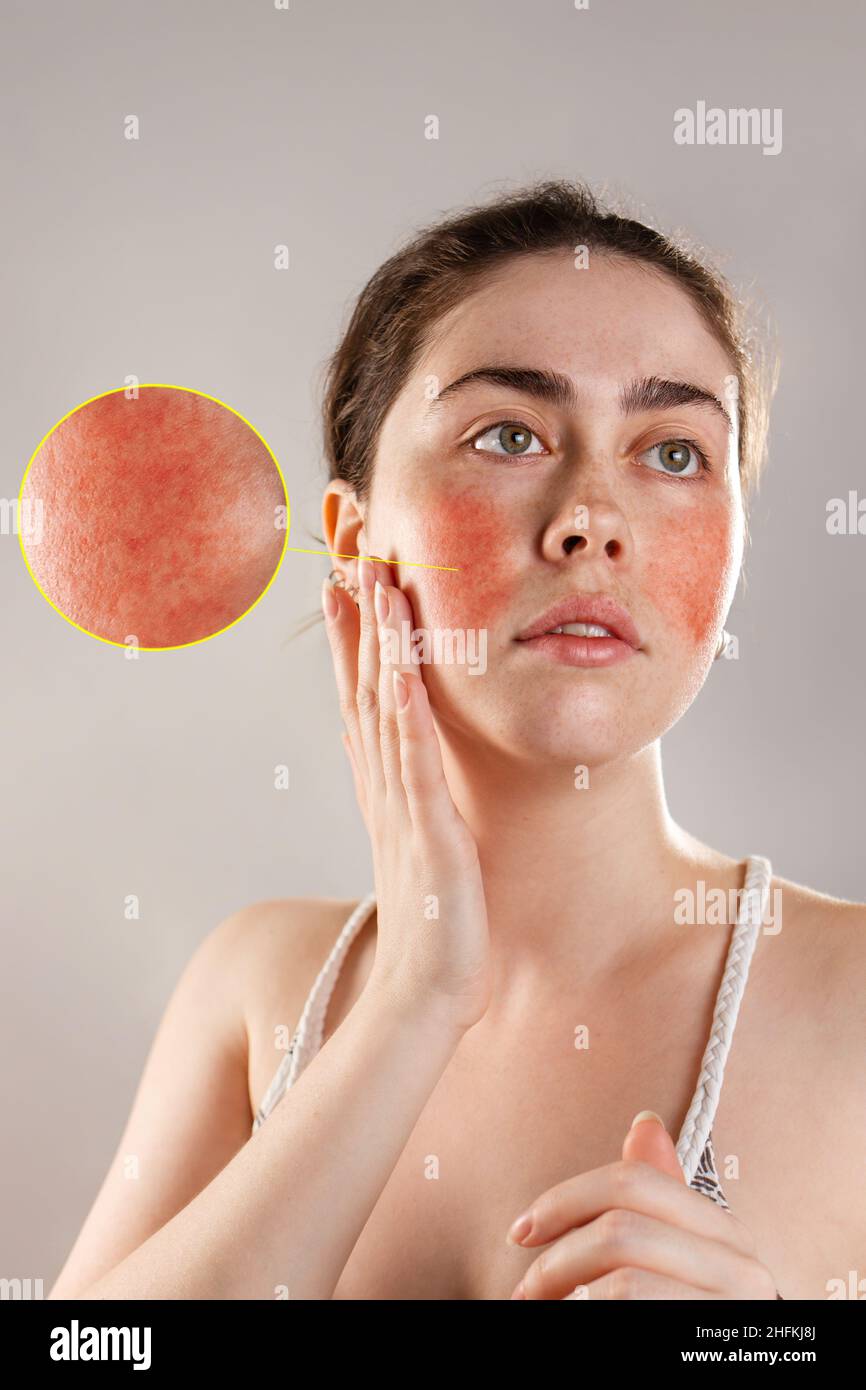 Cosmetology and rosacea. The young woman runs her hands over her ...
