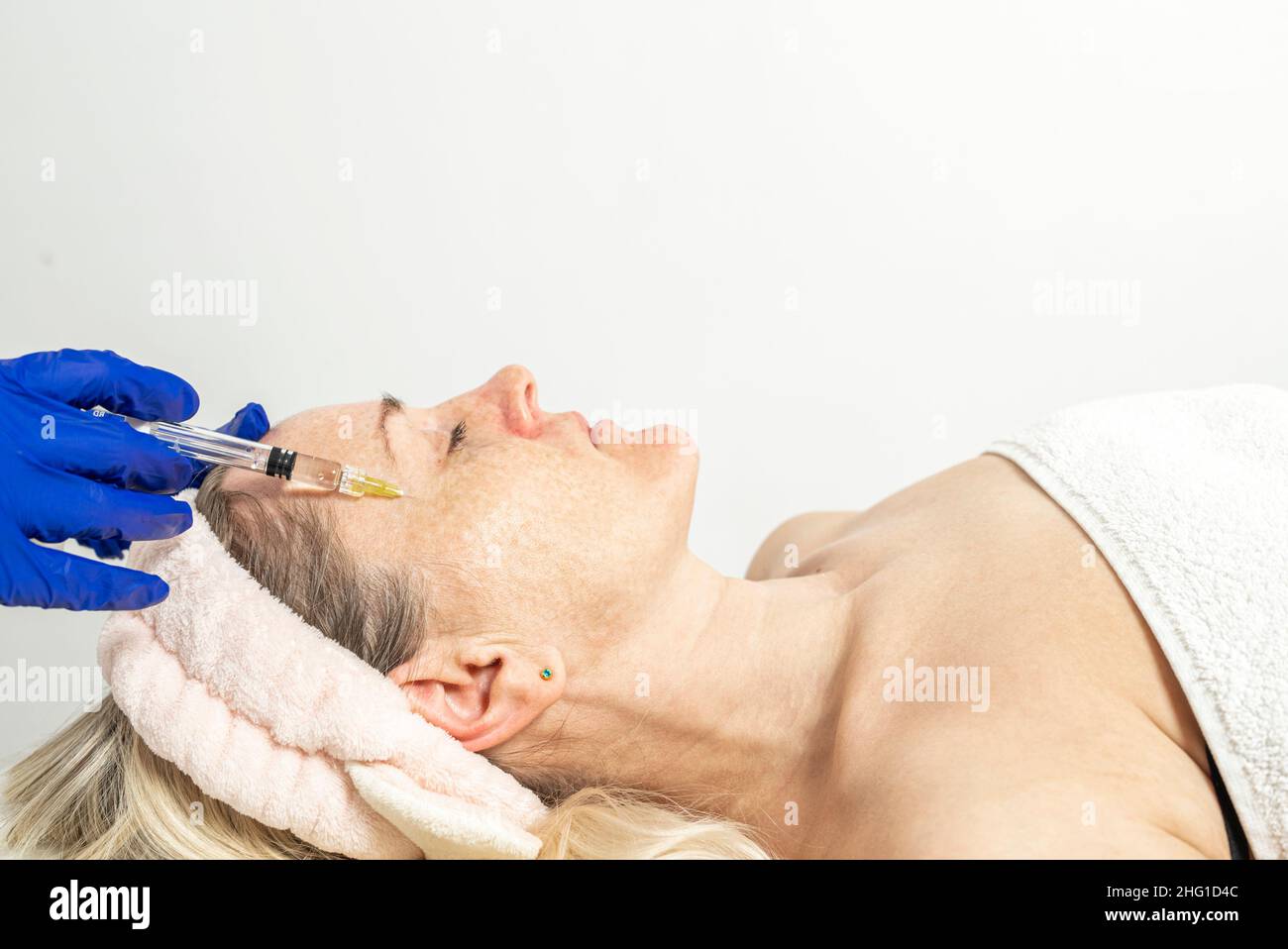 botulinum toxin injection on eye area, for lifting skin around eyes ...