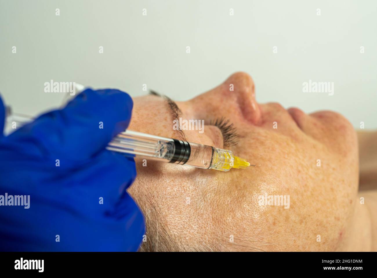 botulinum toxin injection on eye area, for lifting skin around eyes ...