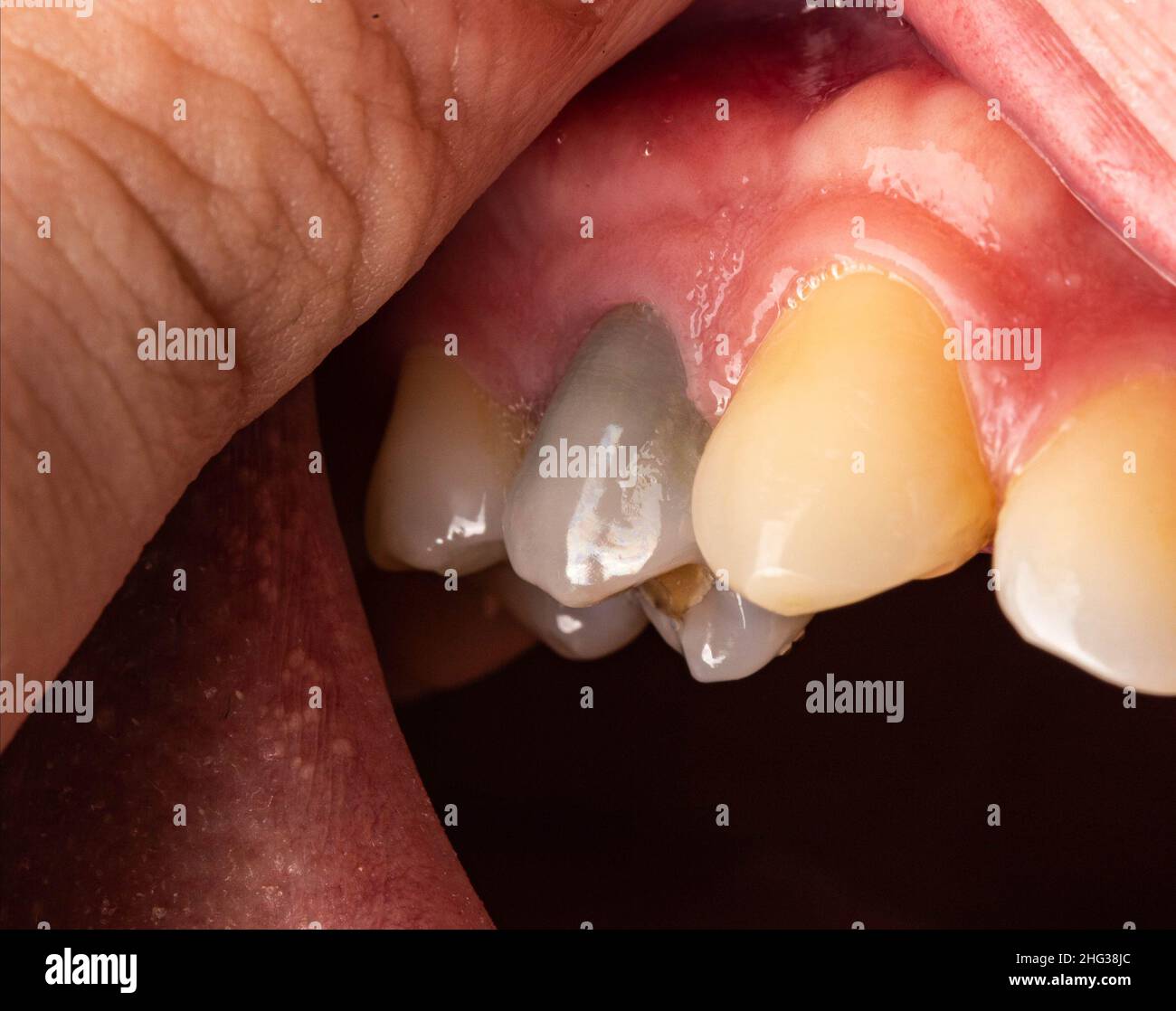 Black tooth in the mouth of a man after nerve depulpation. Dead ...