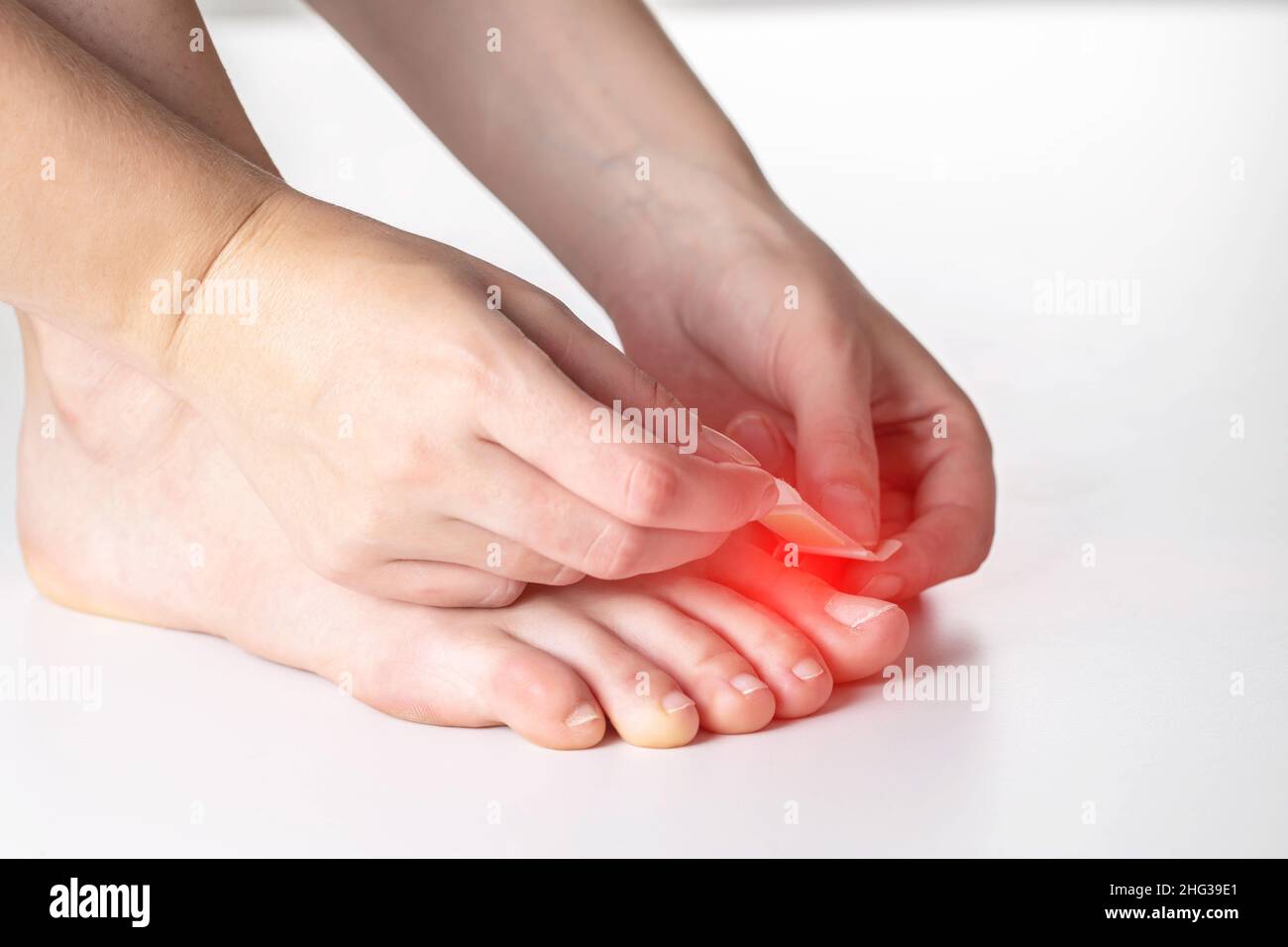 Verruca foot woman hi-res stock photography and images - Alamy