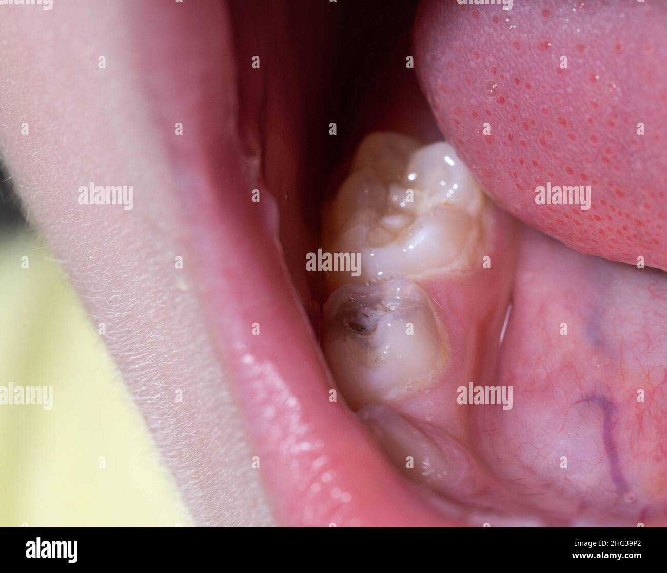 Caries on a baby's tooth, close-up. Concept of dental treatment for ...
