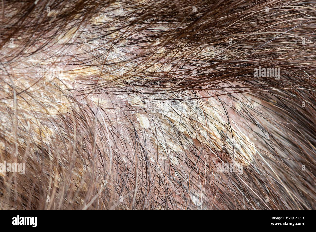 Dandruff Flakes In Hair