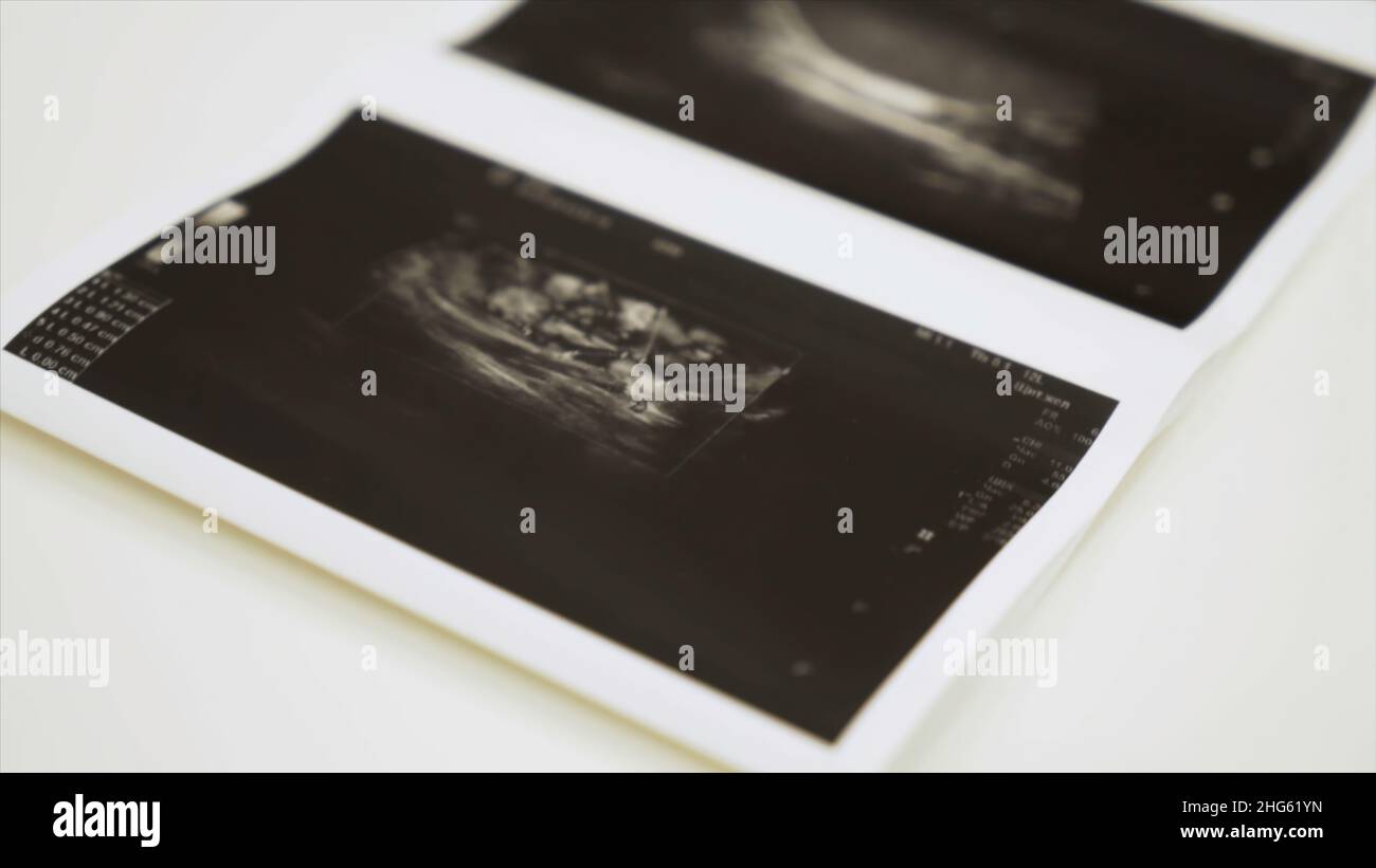 Ultrasound of human internal organs hi-res stock photography and images ...