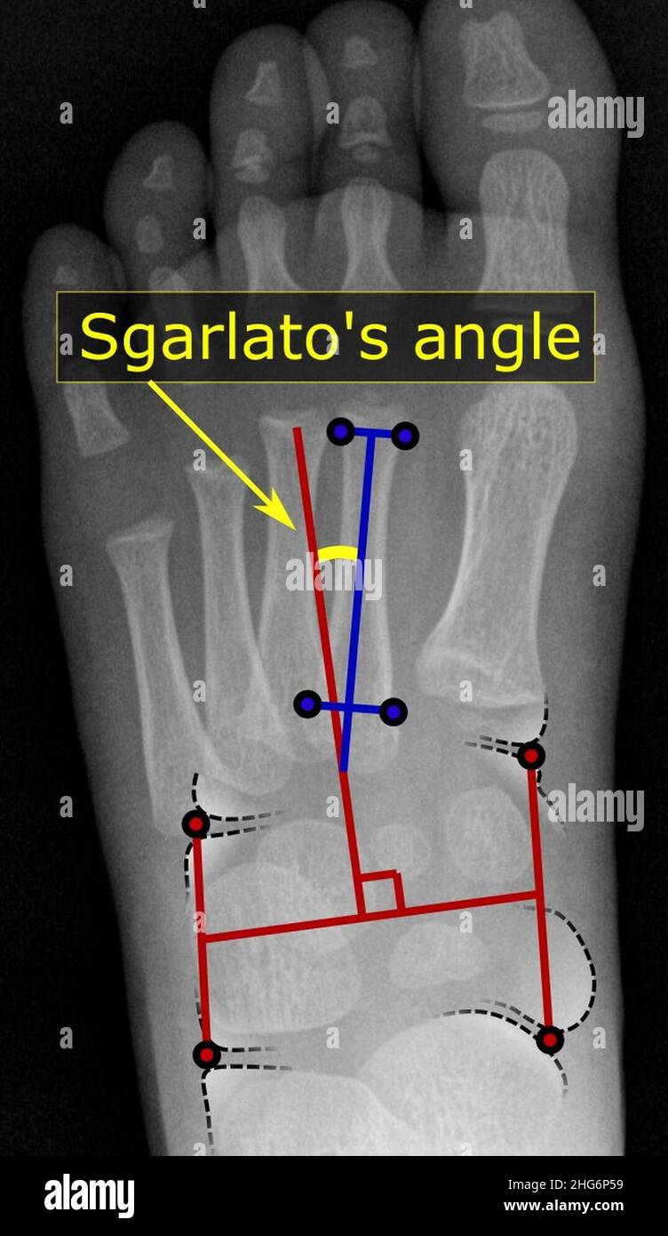 Sgarlato's angle of metatarsus adductus Stock Photo - Alamy